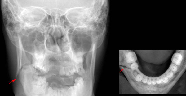 Caso 265 - FRACTURA MANDIBULAR - CDI