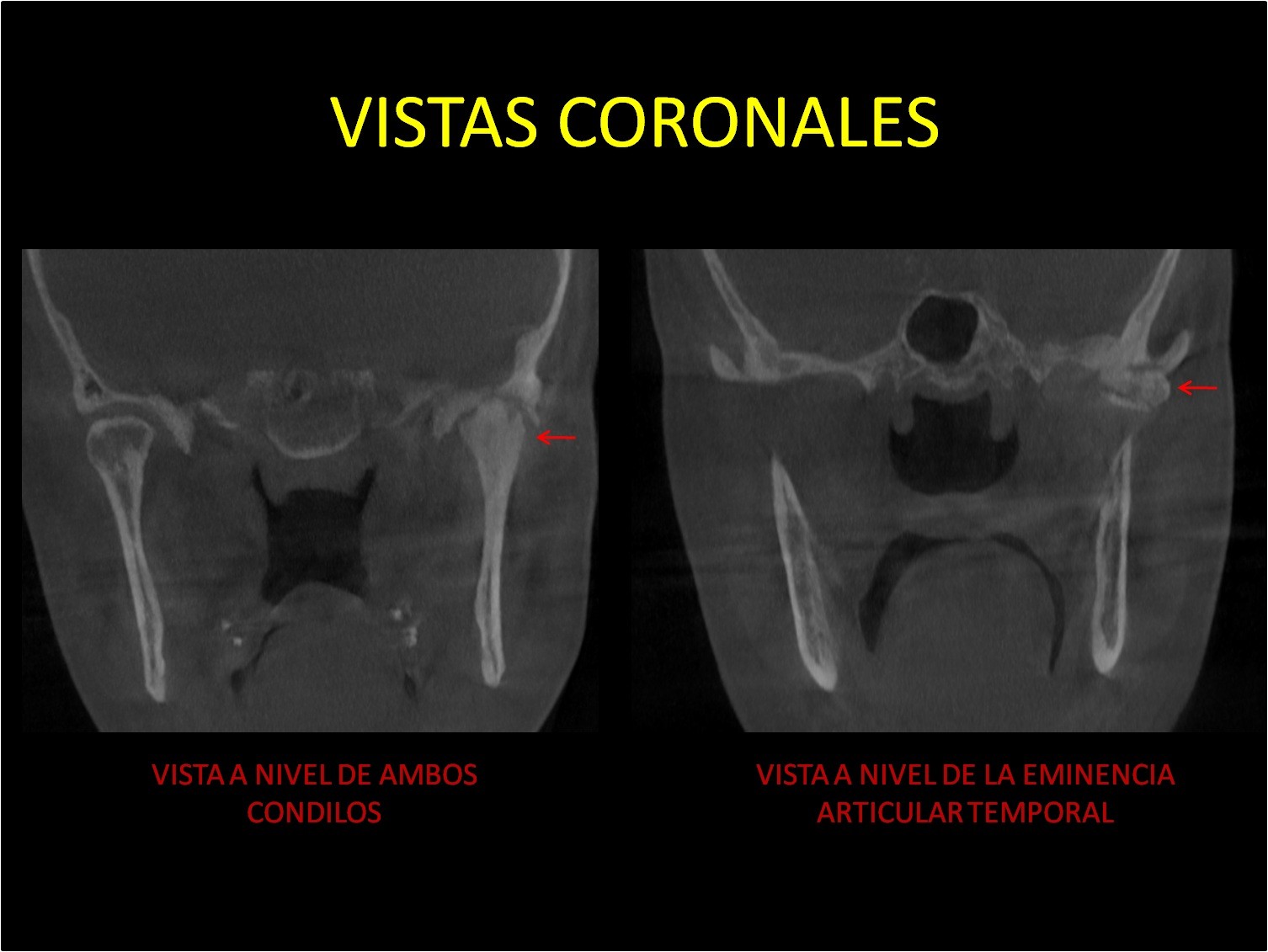 Caso N° 553 : Osteoartrosis de ATM - CDI