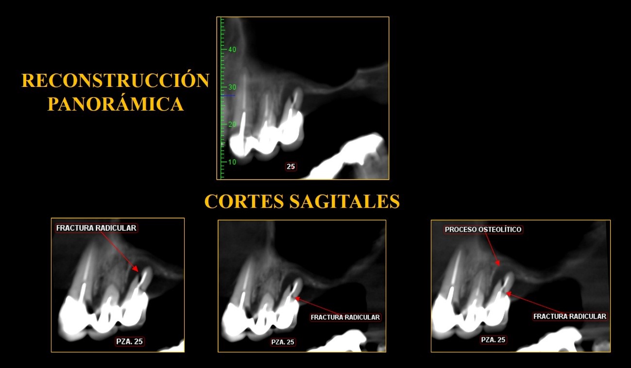 Caso Nº604: Fractura Radicular - CDI