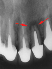 Caso 334 - FRACTURA RADICULAR - CDI