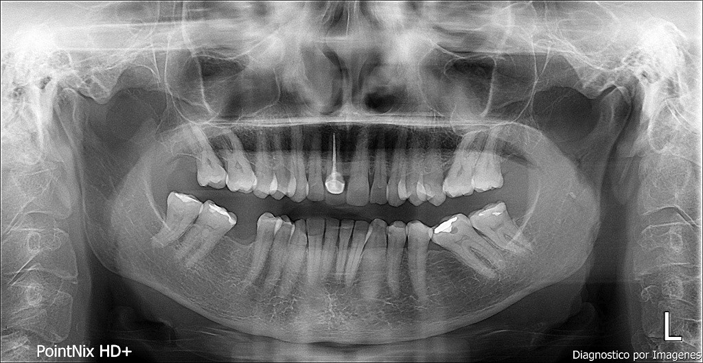 Caso N°560: Fractura Mandibular - CDI