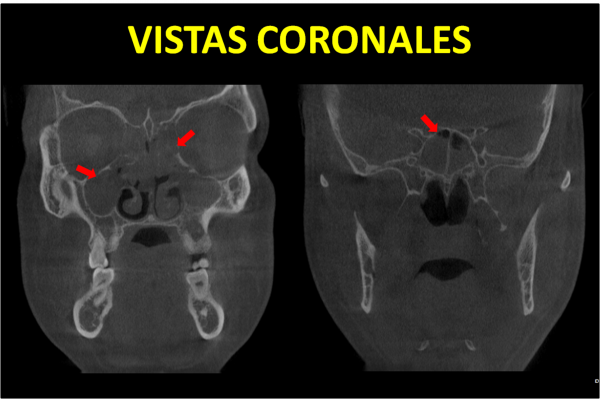 Caso N°540: PANSINUSITIS - CDI