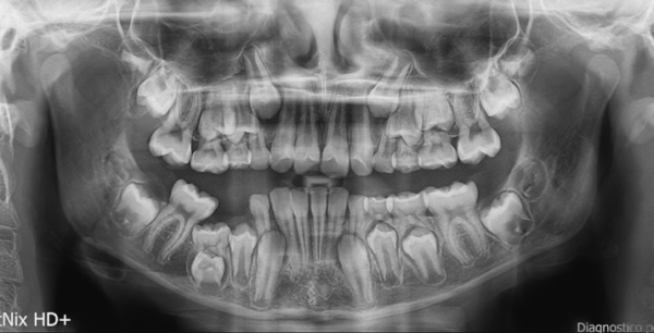 Caso N°526 - DIENTE SUMERGIDO - CDI