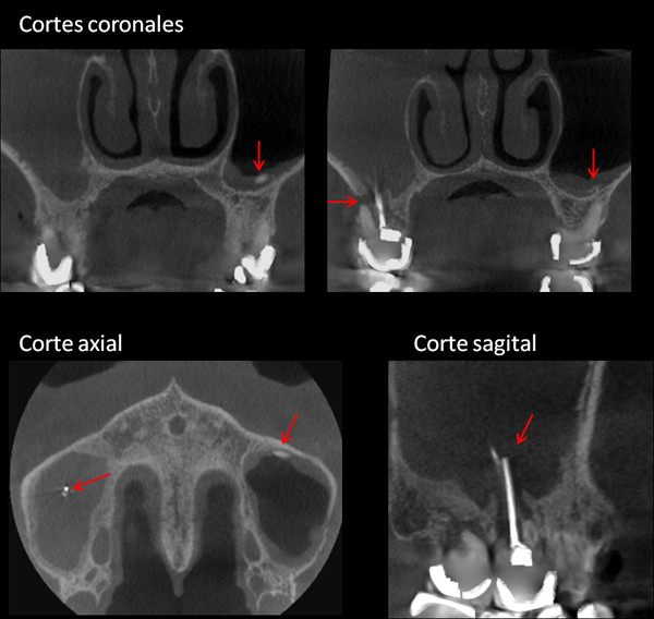 Caso 453 - SINUSITIS ODONTOGÉNICA, PERFORACIÓN RADICULAR. - CDI