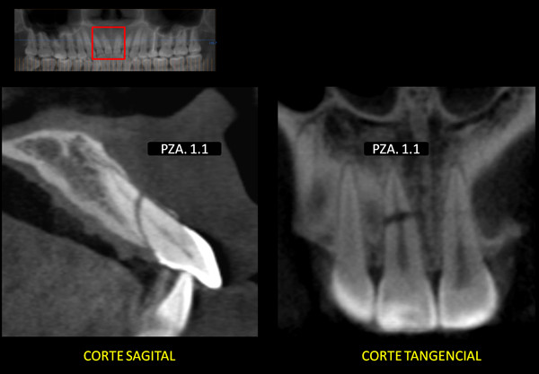 Caso 433 - FRACTURA RADICULAR - CDI