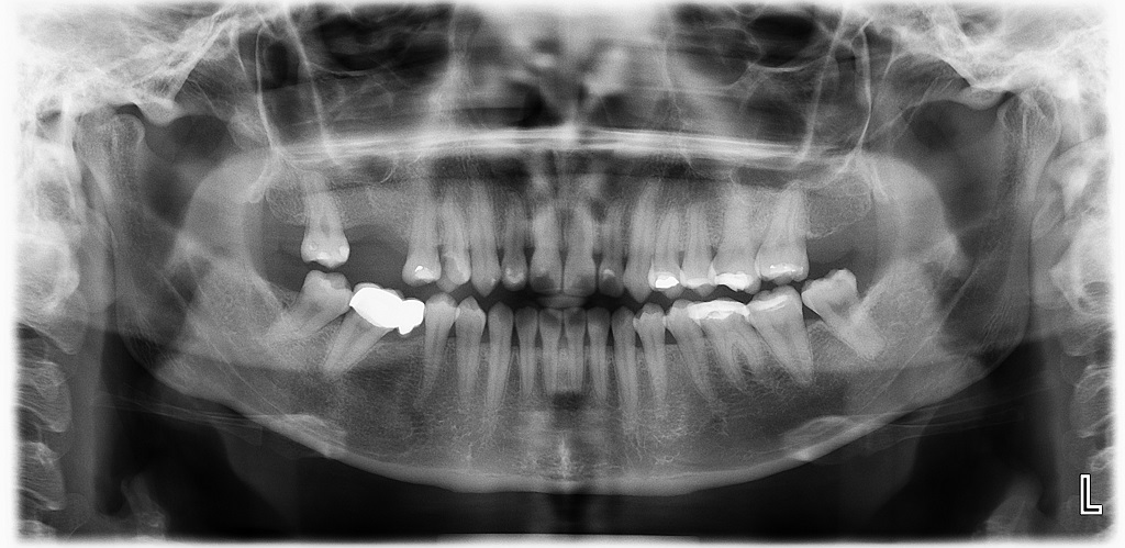 Caso Nº593: Cóndilo Bífido Bilateral - CDI
