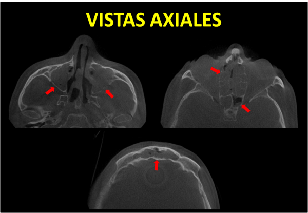 Caso N°540: PANSINUSITIS - CDI