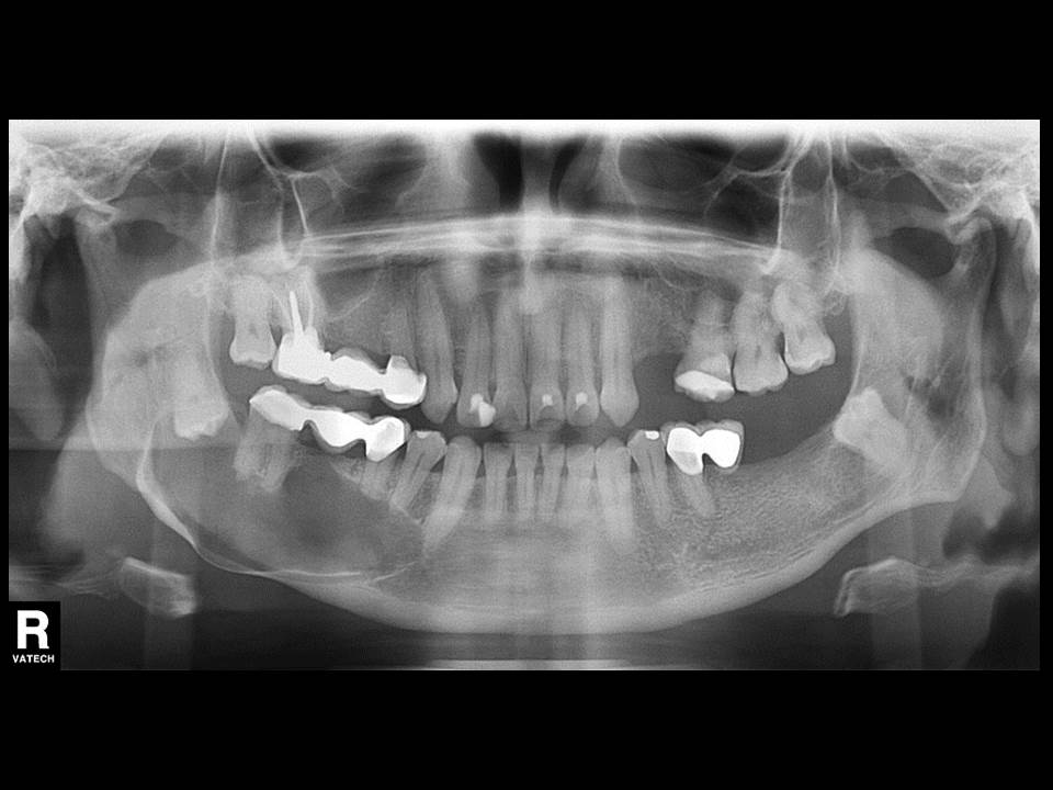 Caso N° 575: Ameloblastoma - CDI