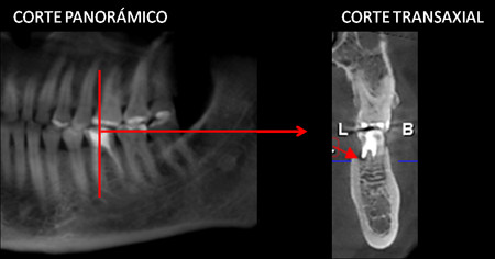 Caso 460 - PERFORACIÓN RADICULAR - CDI