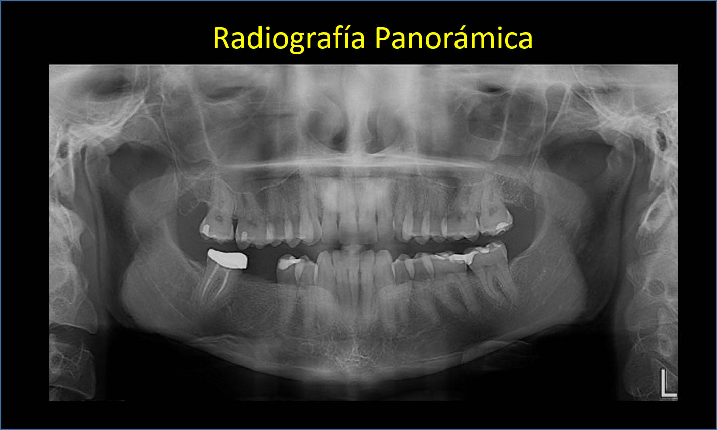 Caso N°582: Pansinusitis Crónica - CDI