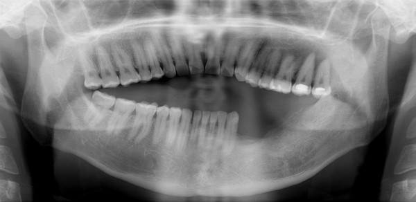 Caso 358 - LUXACIÓN DE ARTICULACIÓN TEMPOROMANDIBULAR - CDI