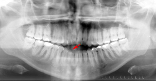 Caso 132 - GEMINACIÓN DENTARIA - CDI