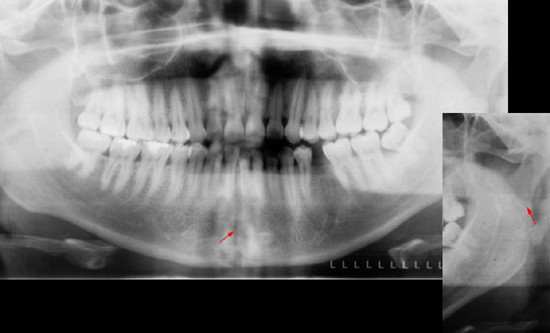 Caso 218 - FRACTURA MANDIBULAR - CDI