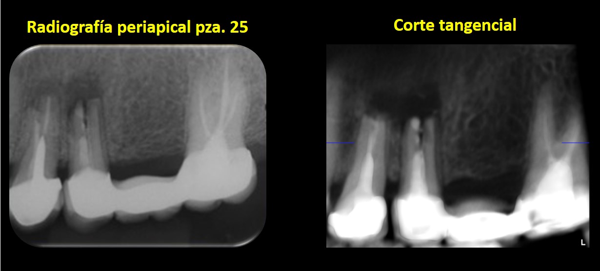 Caso N°577: Fractura Radicular - CDI