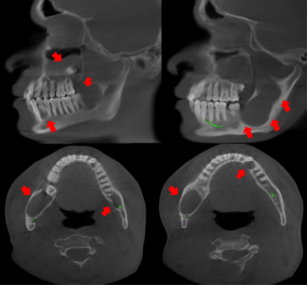 Caso N°522: SÍNDROME DE GORLIN GOLTZ - CDI