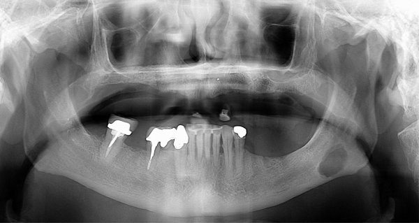 Caso 510 - Defecto de Stafne - CDI