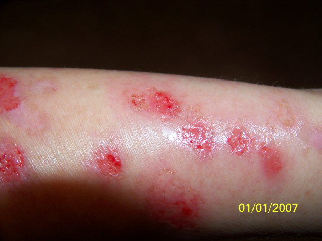 Morgellons Disease Conquered – Why Are You Still Suffering Needlessly ...