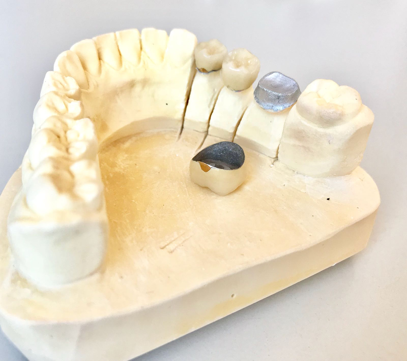 Zahnersatz - Praxis für Zahnheilkunde & Implantologie Dr. med. dent ...