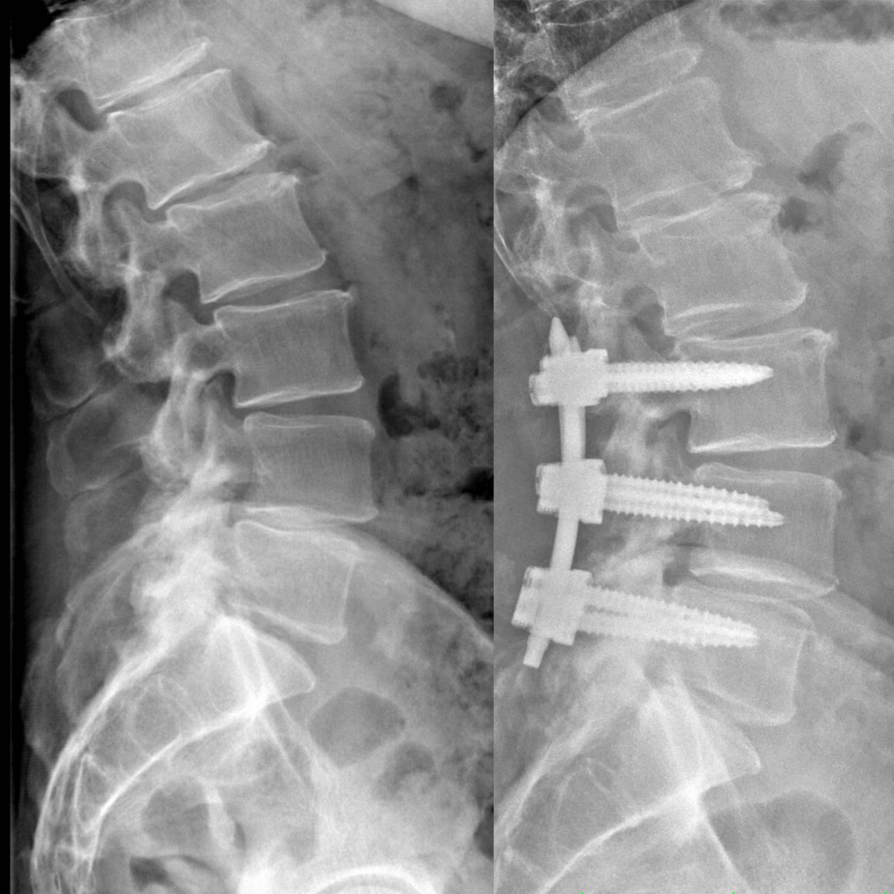 La storia di Rolando e la stenosi lombare - Ortopedico - Chirurgo ...