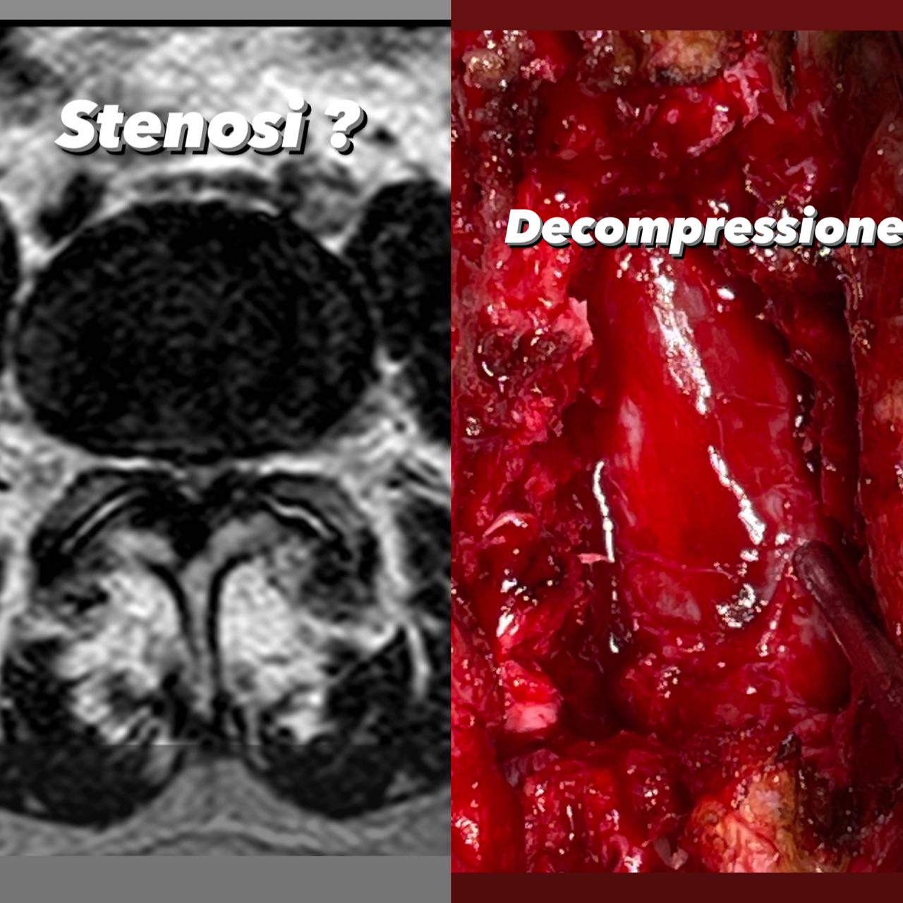 La storia di Rolando e la stenosi lombare - Ortopedico - Chirurgo ...