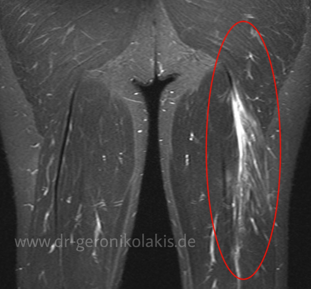 Muskelfaserriss - Dr. Geronikolakis - Facharzt für Orthopädie und ...