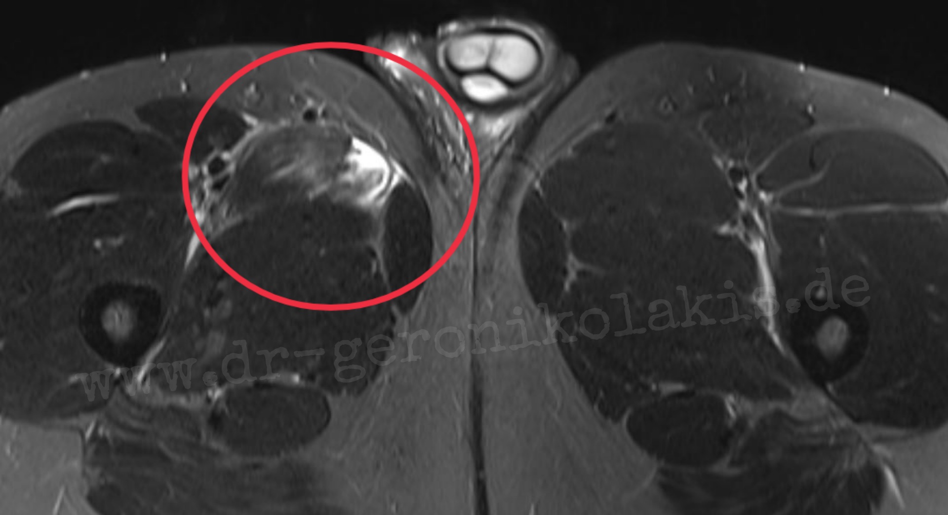 Muskelfaserriss - Dr. Geronikolakis - Facharzt für Orthopädie und ...