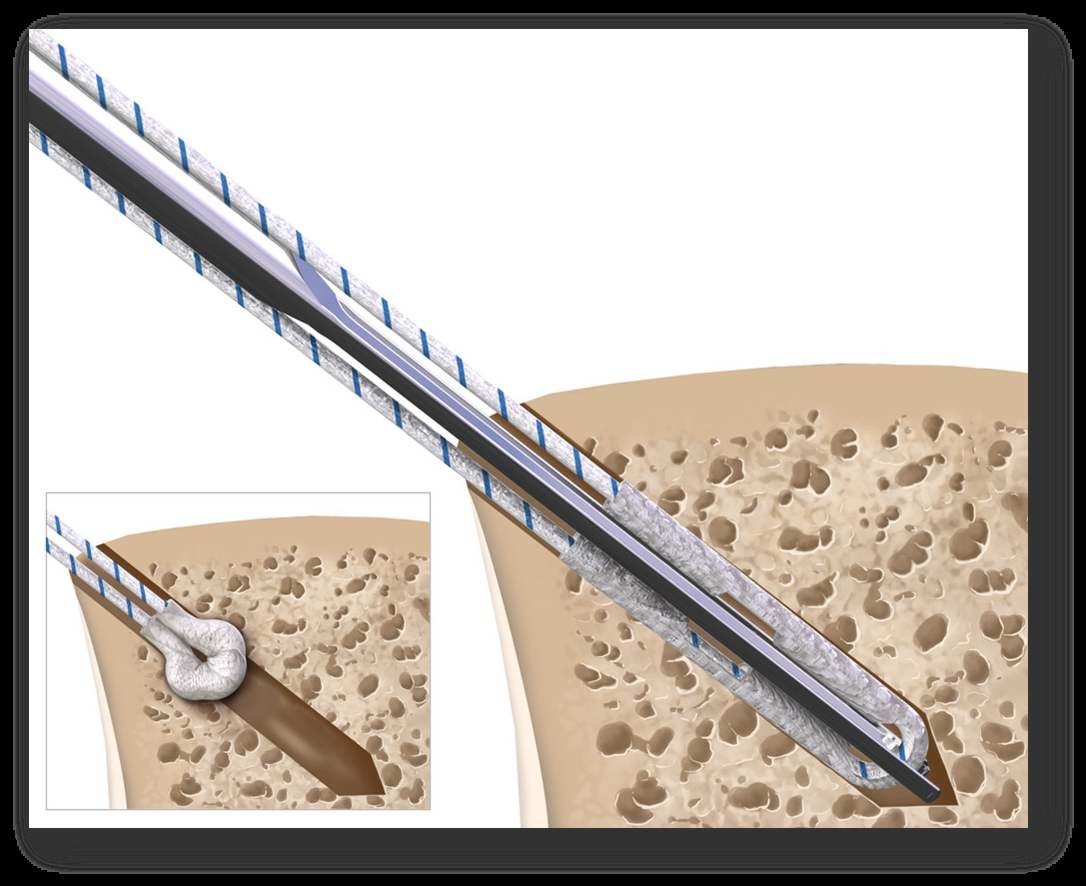 Schulterluxation und Labrumläsion - SPORTCHIRURGIE Heidelberg