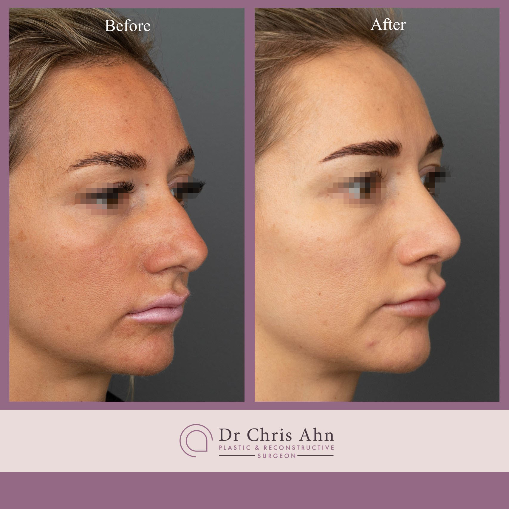 Rhinoplasty - before and after - Dr Chris Ahn - Specialist Plastic Surgeon