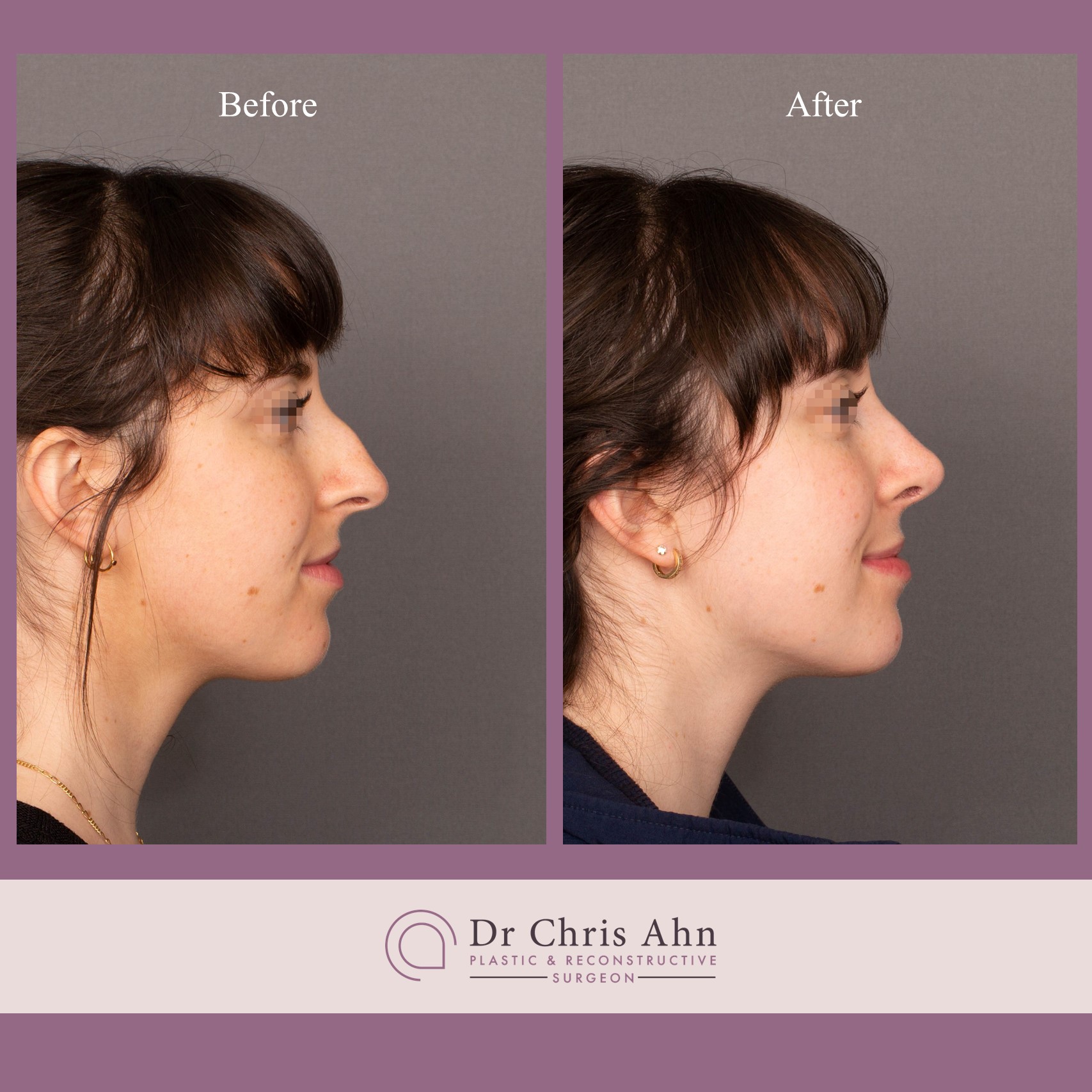 Rhinoplasty - before and after - Dr Chris Ahn - Specialist Plastic Surgeon
