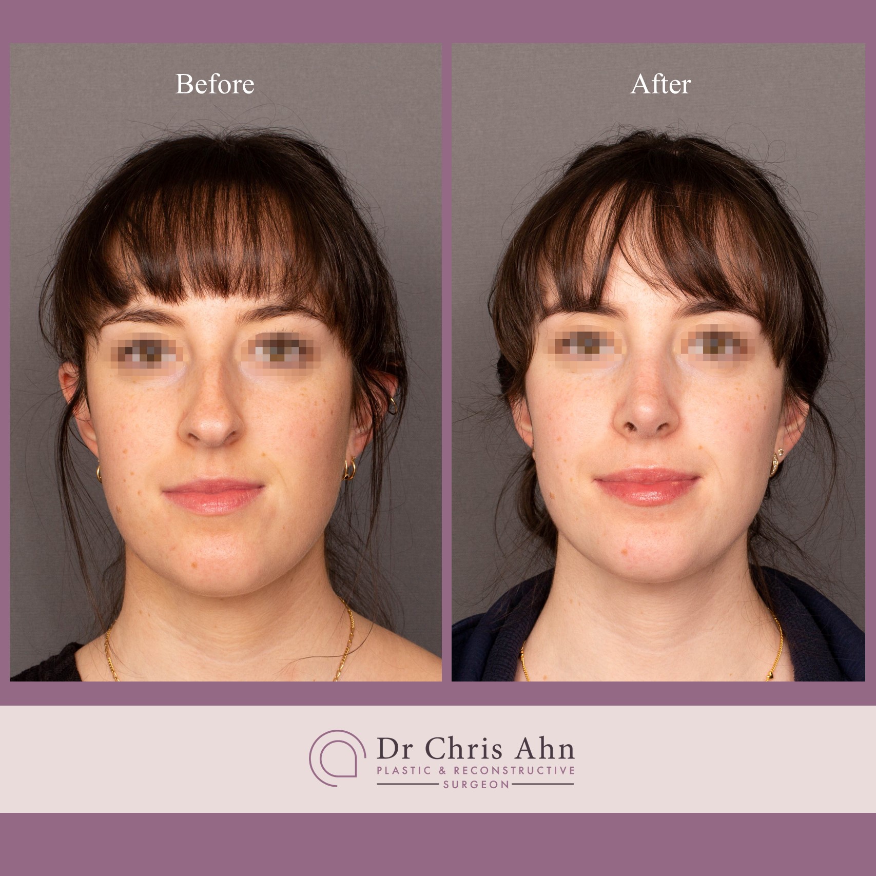 Rhinoplasty - before and after - Dr Chris Ahn - Specialist Plastic Surgeon