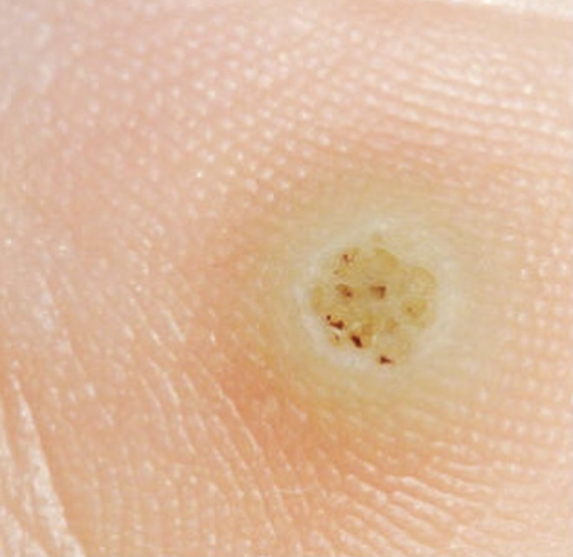 Warzen / Verrucae - PODONORD