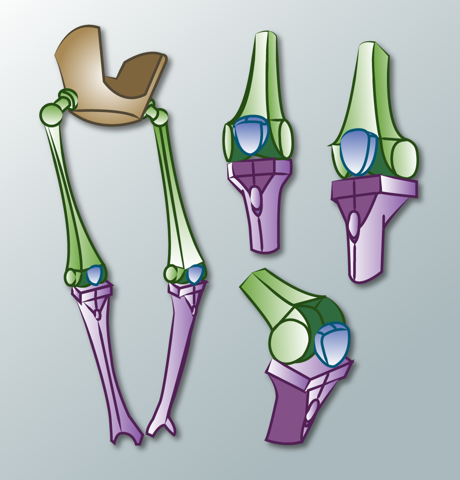 Extremidades inferiores - Guía Poly-Clay