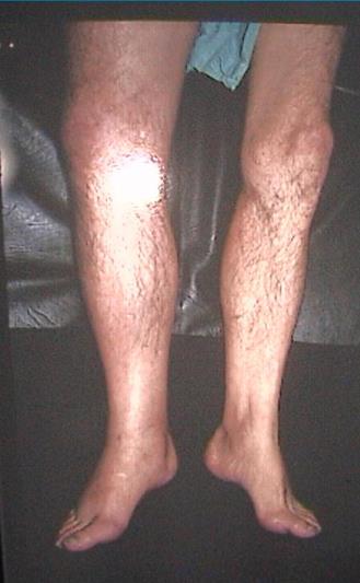 Flebitis alta - Página web de flebologiaylinfologialaplata