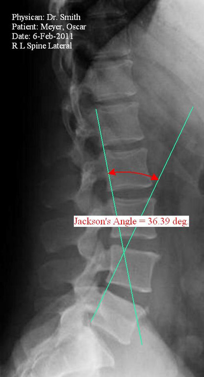 Guided Mark-up: Lumbar Spine Measurements - Metron-Imaging
