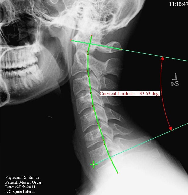 Perfect Cervical Spine X Ray Dancekery