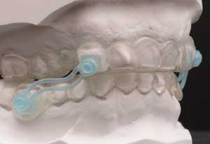 Schnarchschienen (IST-System) - Gutzwiller Dental