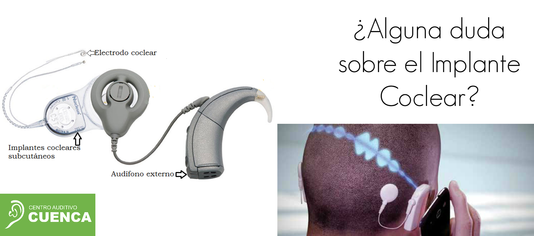 ¿Dudas sobre el Implante Coclear? - Centro Auditivo Cuenca, audífonos ...