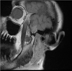 Imagerie des pathologies de l'articulation temporo-mandibulaire par Gil ...