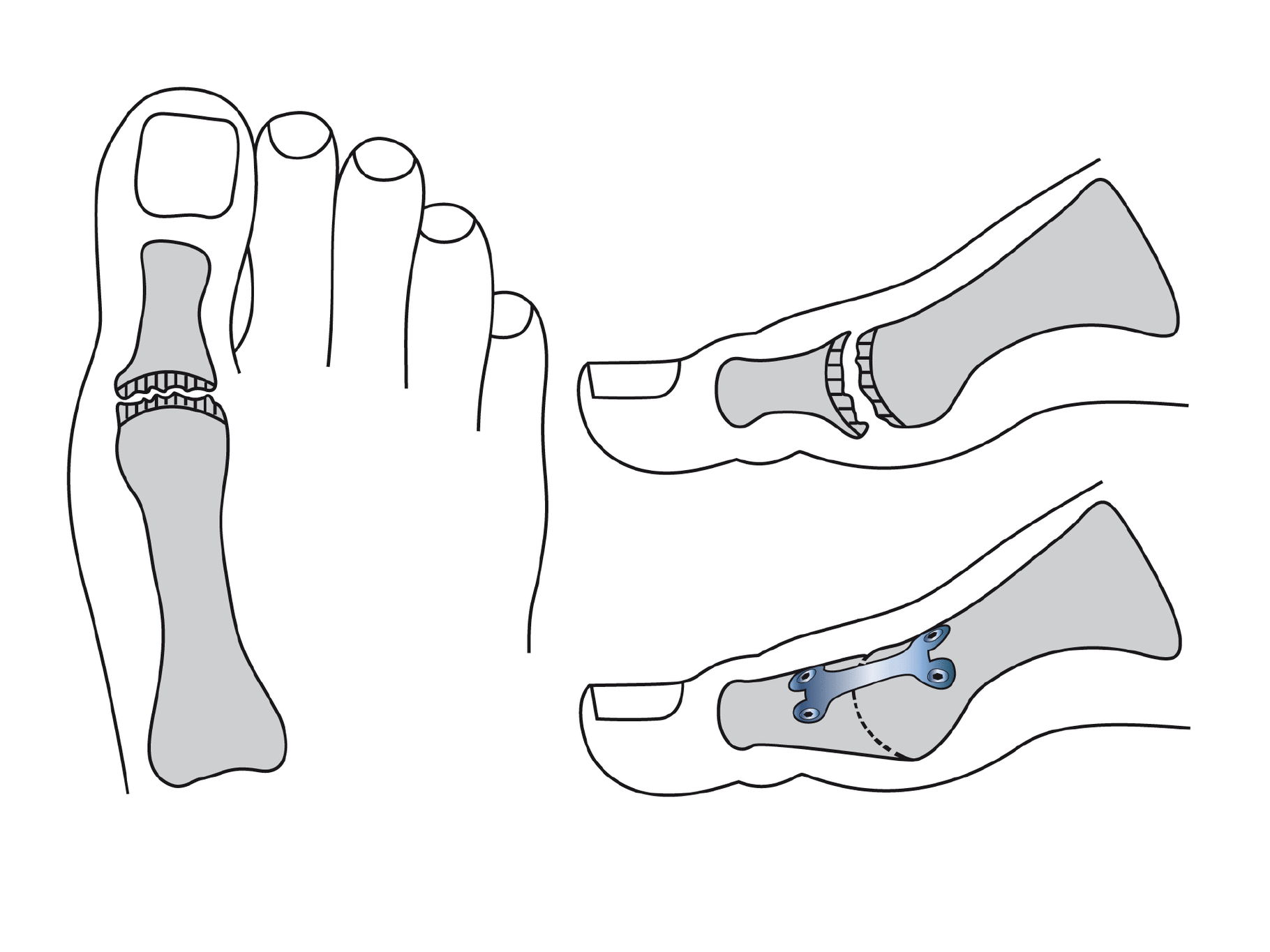Arthrose des Grosszehengrundgelenks = Hallux rigidus - ortho-clinics ...