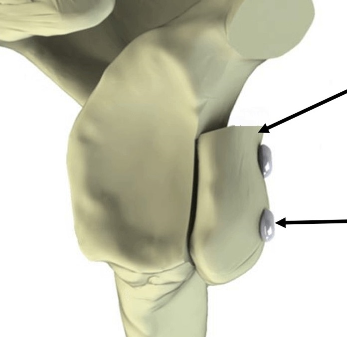 Schulterluxation = Ausrenkung der Schulter - ortho-clinics Webseite!