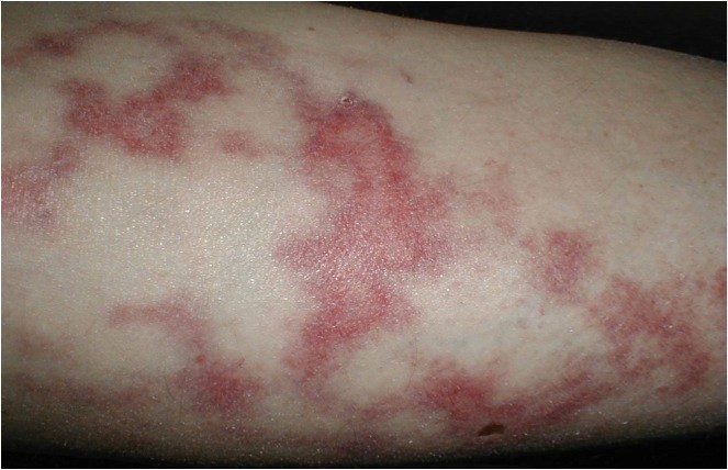 Welcome to the AAAAI/ACAAI Allergy Practice Parameters Website ...