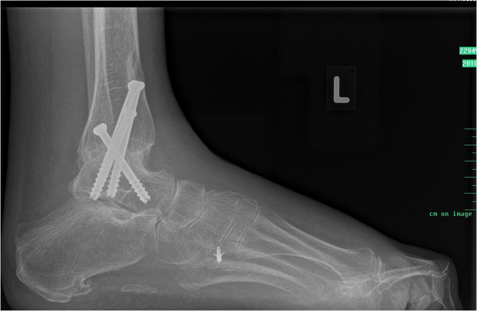 Arthrose des oberen oder unteren Sprunggelenkes - Orthopädische Praxis ...