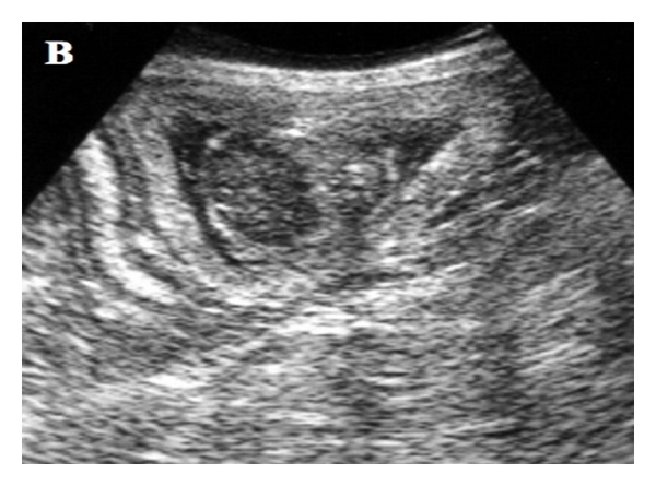 Ultrasound Determination of Gestational Age Using Placental Thickness ...