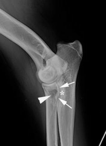 A chondroblastic osteosarcoma of the coronoid process mimicking a ...
