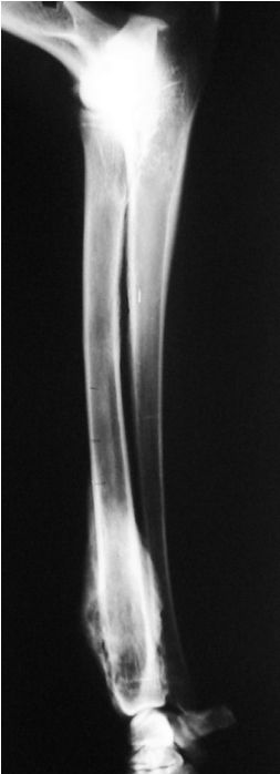 Ipsilateral vascularised ulnar transposition autograft for limb ...
