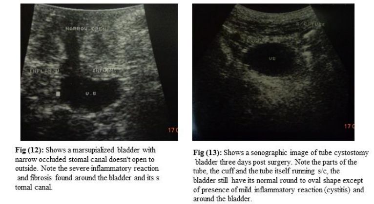 Tube Cystostomy VS Bladder Marsupialization: Clinical and ...