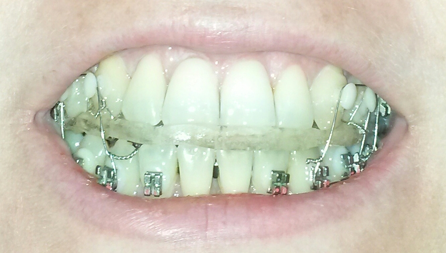 Die Operation - Erfahrung Kiefer-OP