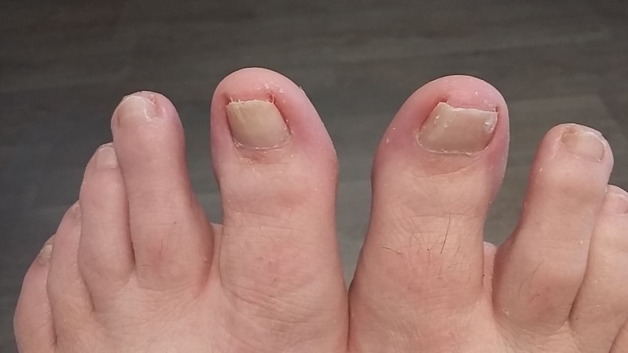 Ongle incarné : L'urgence en podologie ! - Podologue Nice Brigitte Haiblet