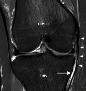 Pes-Anserinus-Syndrom - Mikroinvasive Therapie Bern