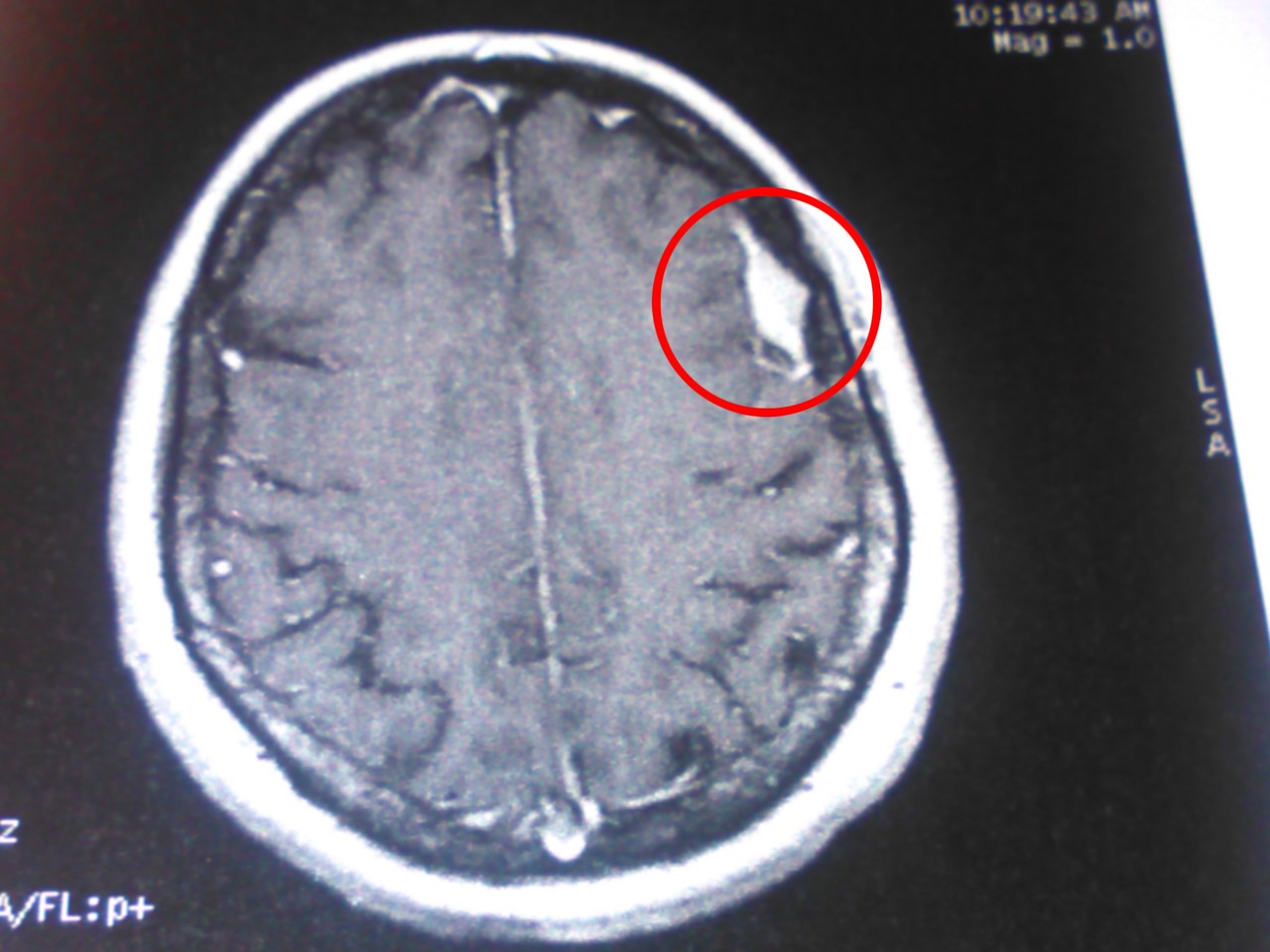 Diagnose Gehirntumor (Meningeom) was nun ?????? - Lisa`s und Peter`s Reich